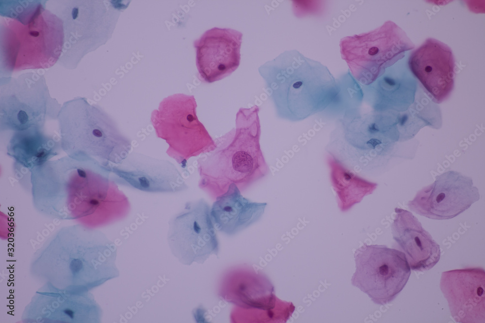 View in microscopic of Abnormal human cervix cells.Squamous epithelium ...