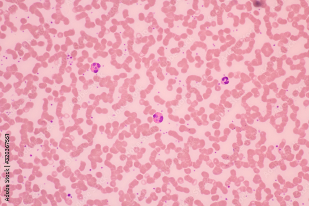 Human blood smear view in microscopy.Complete blood count for treatment ...