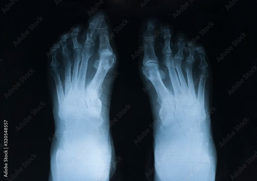 Rheumatoid Arthritis X Ray Foot