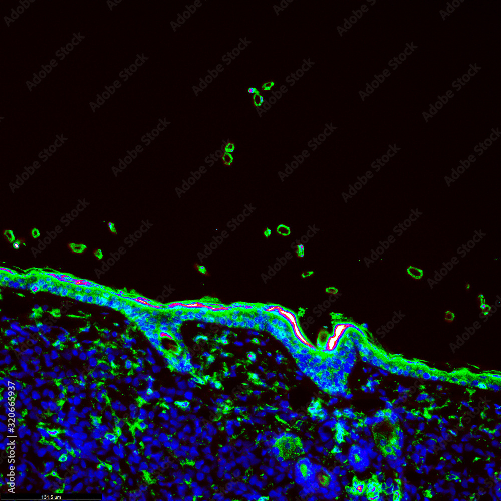 Tumour immunofluorescence IHC image of immunotherapy treatment. Tumor ...