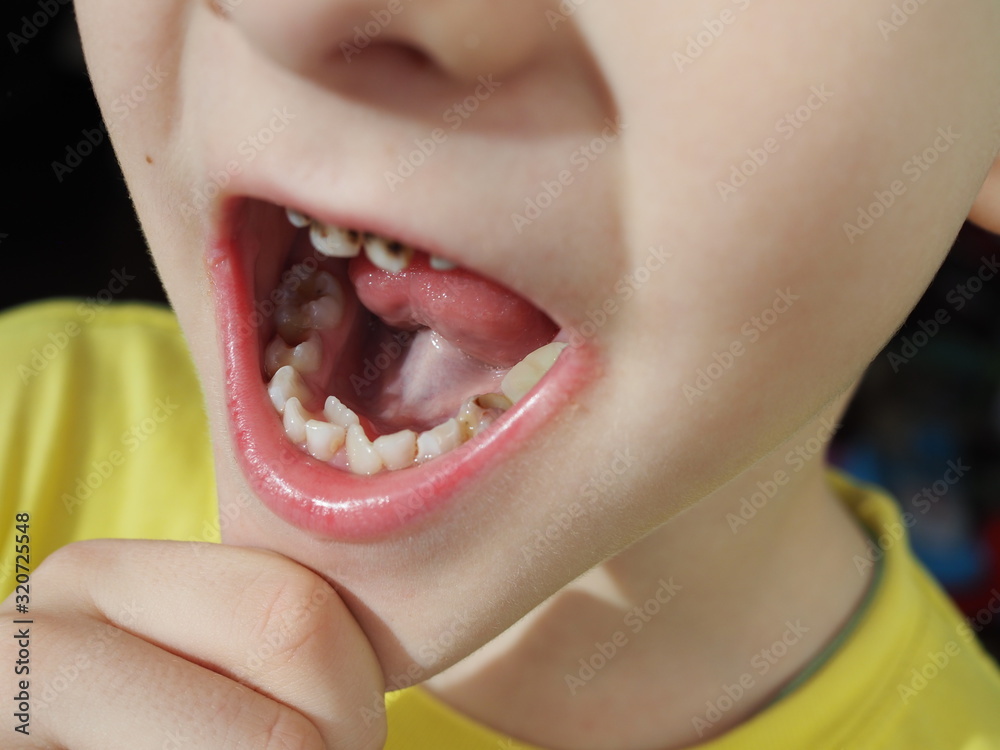 Abnormal boy tooth. The extra narrow strange tooth grew in the boy's ...