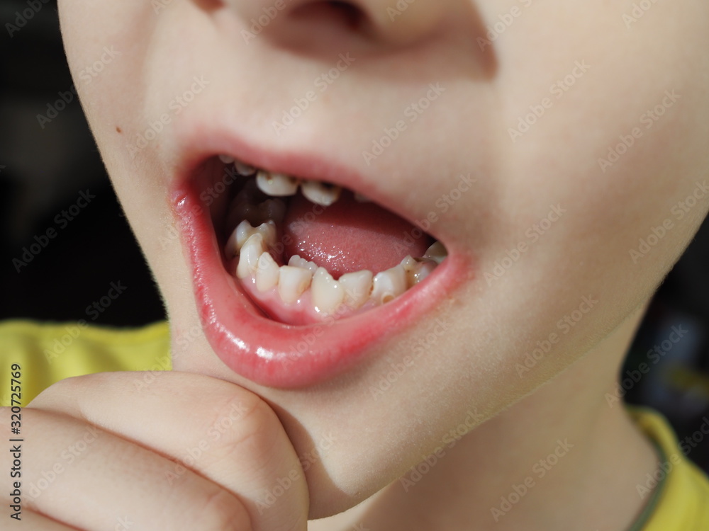 Abnormal boy tooth. The extra narrow strange tooth grew in the boy's ...