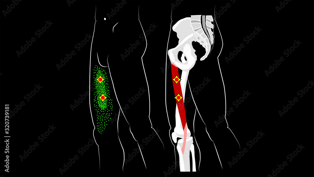 Gracilis muscle. Structure, trigger points, and reflected pain in the ...