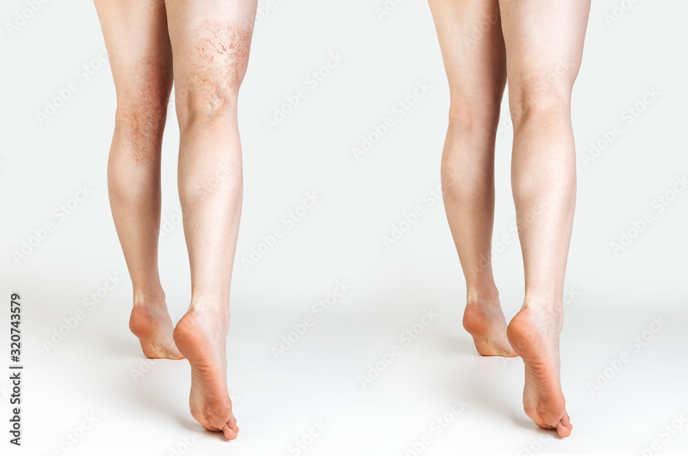 The concept of varicose veins and cosmetic treatment. A caucasian woman ...