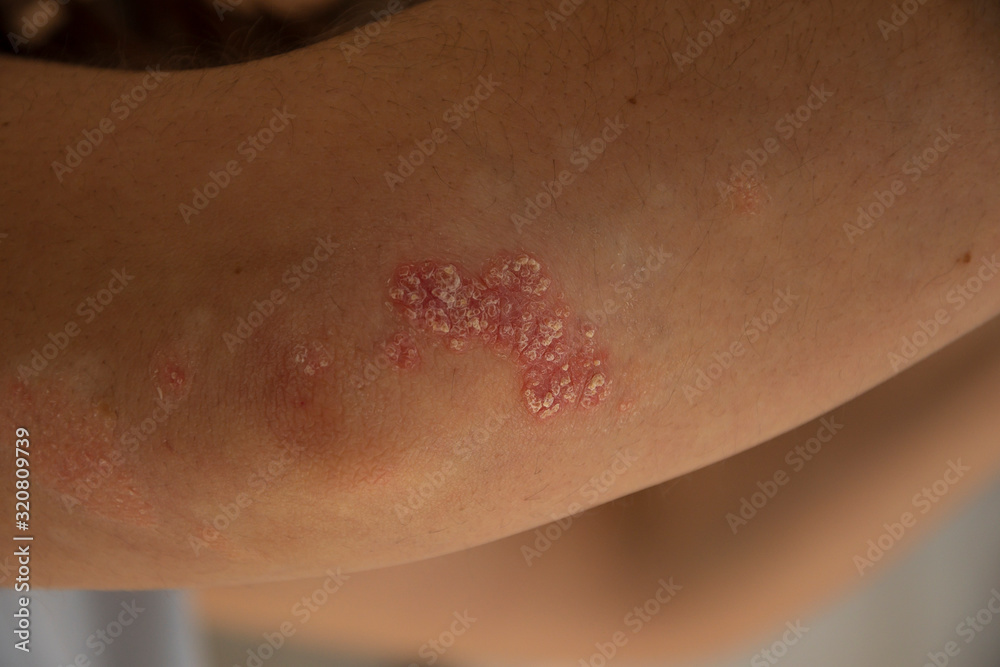 Skin disease on the elbow of a young girl, psoriasis, eczema or ...