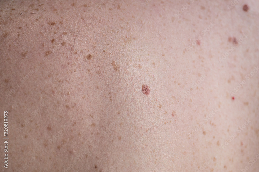 Checking benign moles. Close up detail of the bare skin on a man back ...