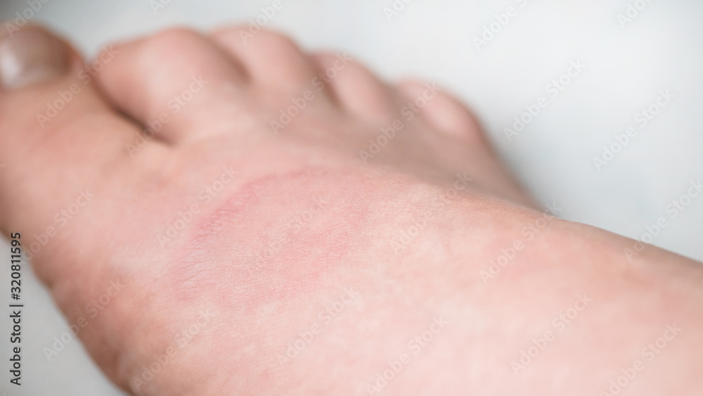 Human leg with Granuloma Annular or a pink lichen. Skin disease. Stock ...