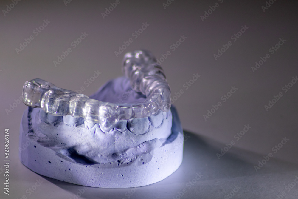 Zähneknirschen per Kieferorthopädie, Aufbissschiene, Knirscherschiene ...