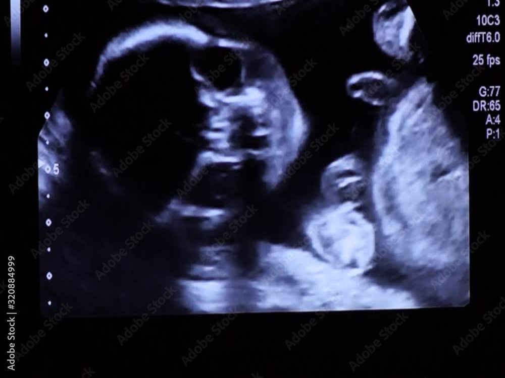 Cute little baby fetus face looking directly on the screen with tiny ...