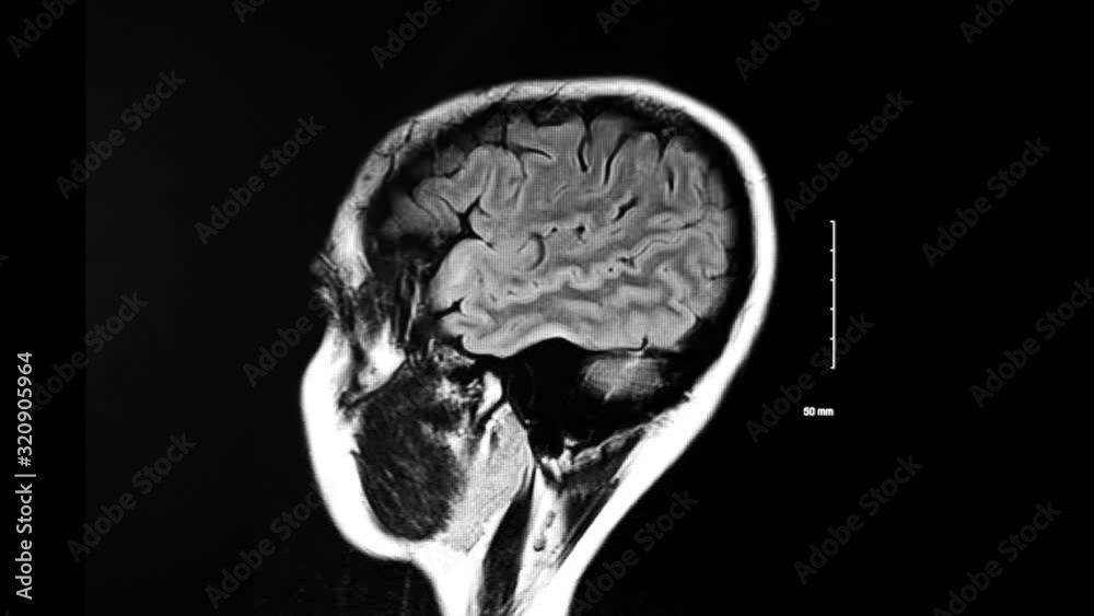 Vídeo do Stock: Sagittal view of an abnormal MRI scan of the brain ...