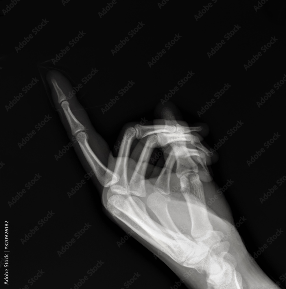 normal x-ray of the hand bones and fingers Stock Photo | Adobe Stock