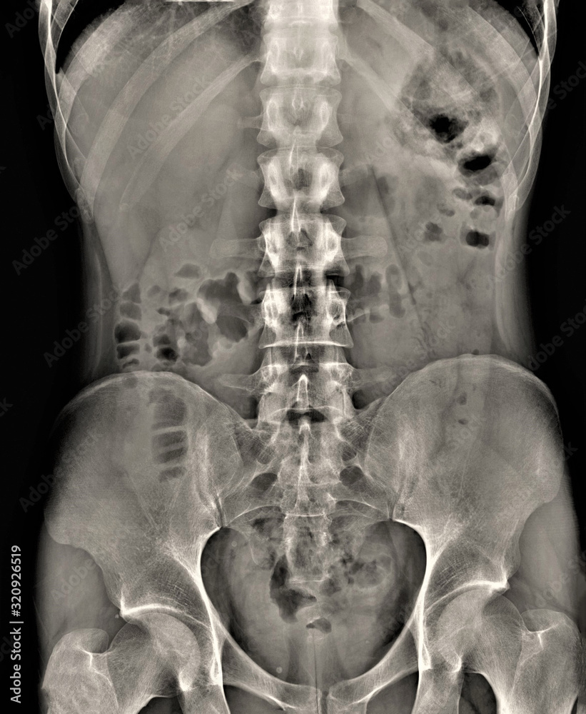 x-ray of the abdominal cavity and pelvis in direct projection, medical ...