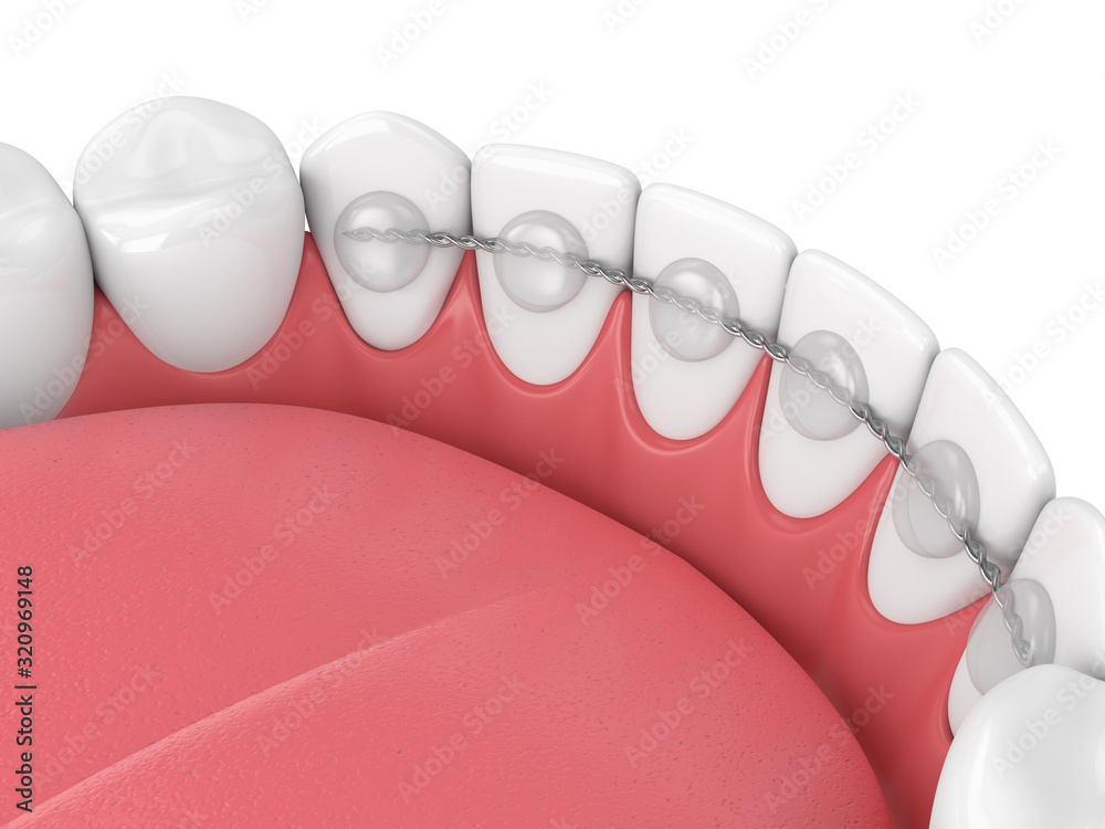3d render of dental bonded retainer on lower jaw Stock Illustration ...