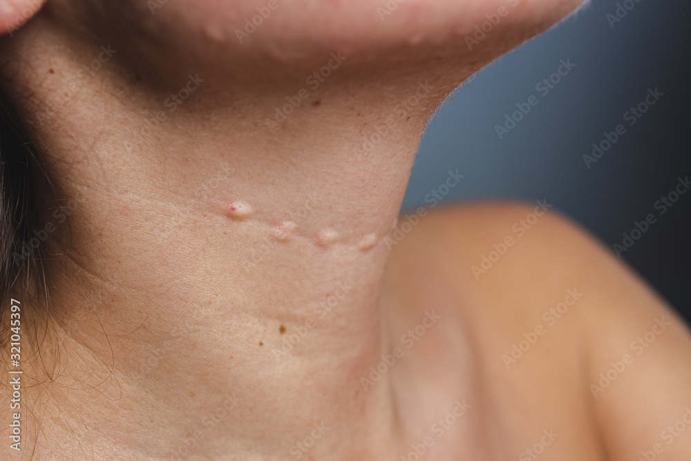 Real skin Biorevitalization. Traces of biorevitalization injections on ...