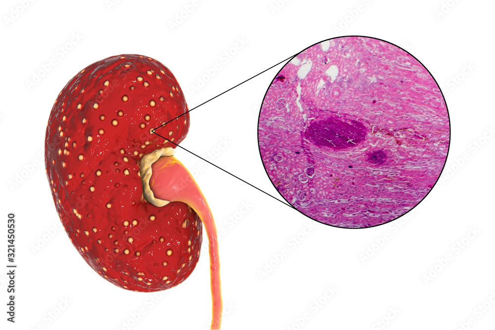 Acute pyelonephritis, 3D illustration showing gross morphology with ...