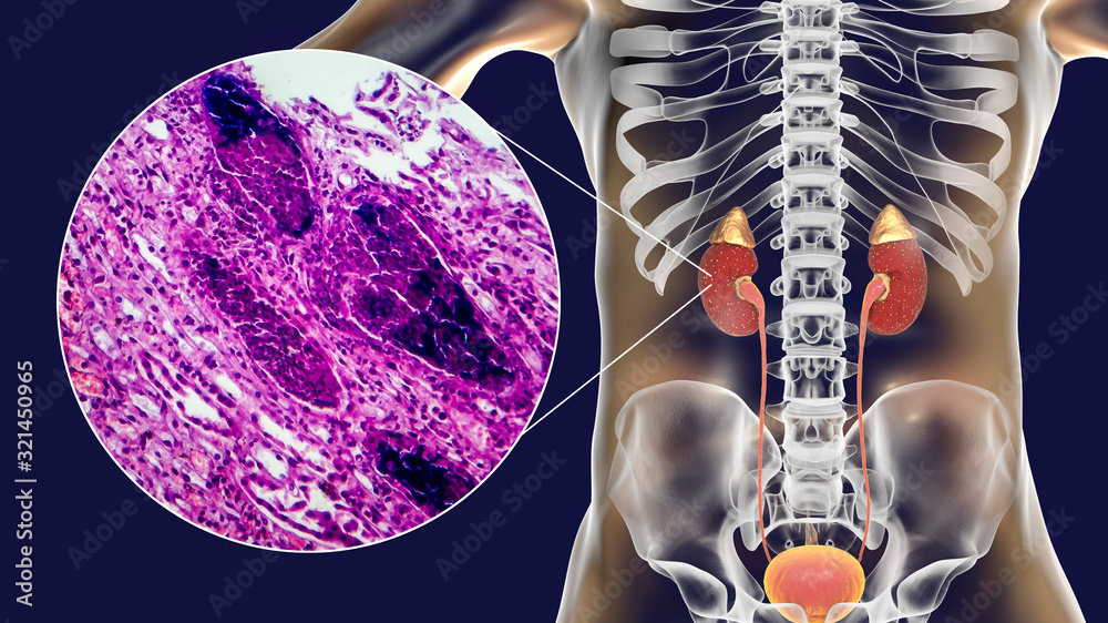 Acute pyelonephritis, 3D illustration showing gross morphology with ...