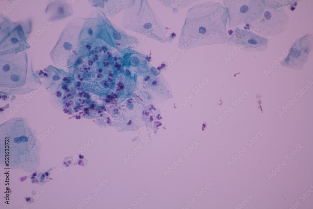 View in microscopic of Candidiasis, fungus infection (Yeast and ...