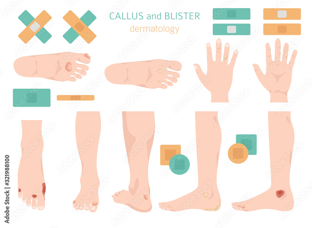 Callus, corn and blister feet and hands. Dermatology. Medical desease ...