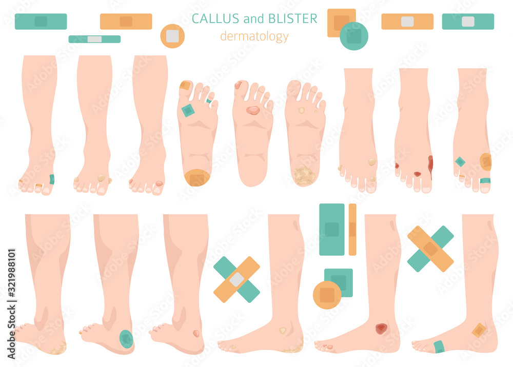 Callus, corn and blister feet and hands. Dermatology. Medical desease ...