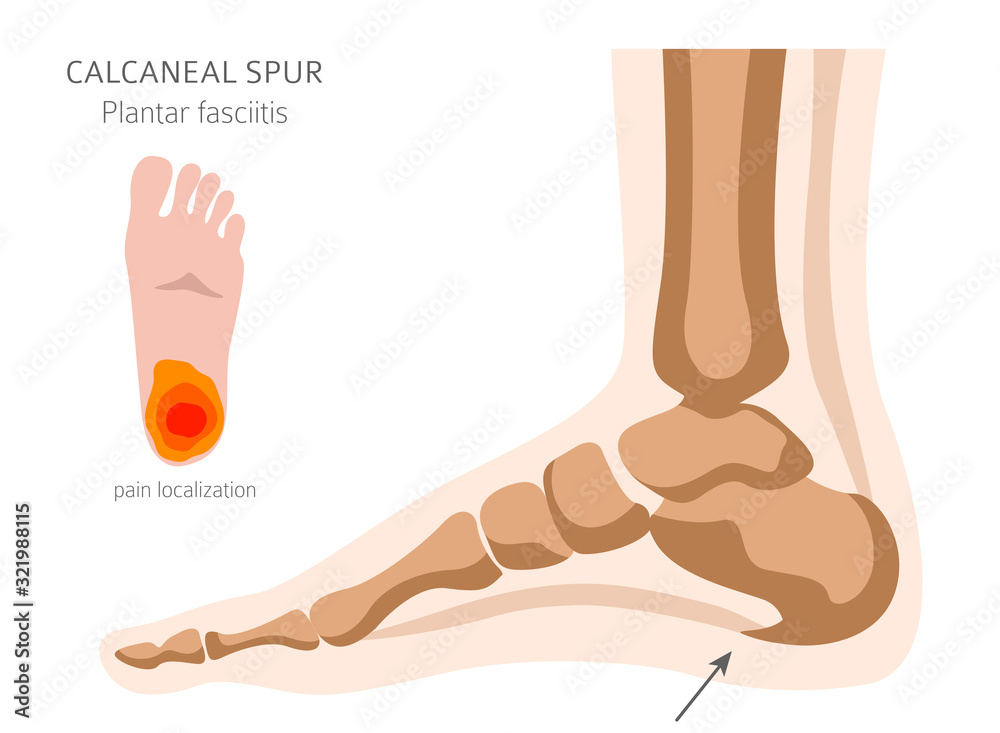 Calcaneal spur. Plantar fasciitis set. Medical desease infographics ...
