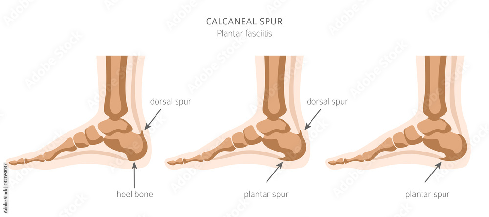 Calcaneal spur. Plantar fasciitis set. Medical desease infographics ...