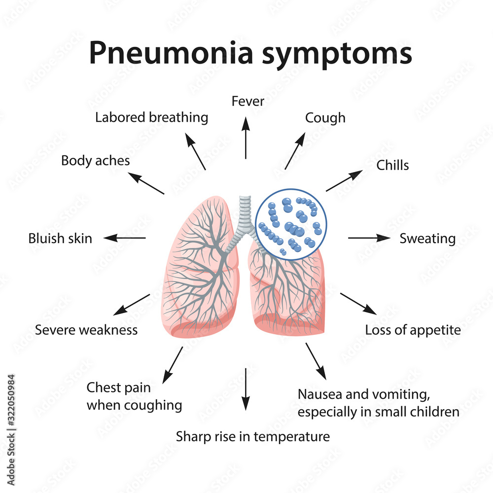 Pneumonia symptoms. Image of human lungs infected Streptococcus ...