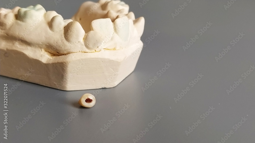 Model of the lower human jaw with crooked teeth, sculpted by a dentist ...