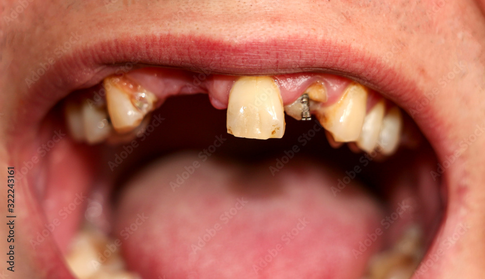 open mouth with broken, diseased teeth affected by caries and ...