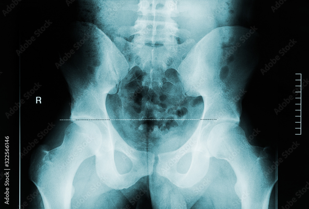 Back view x-ray image of male pelvis, femoral neck and lumbar vertebrae ...