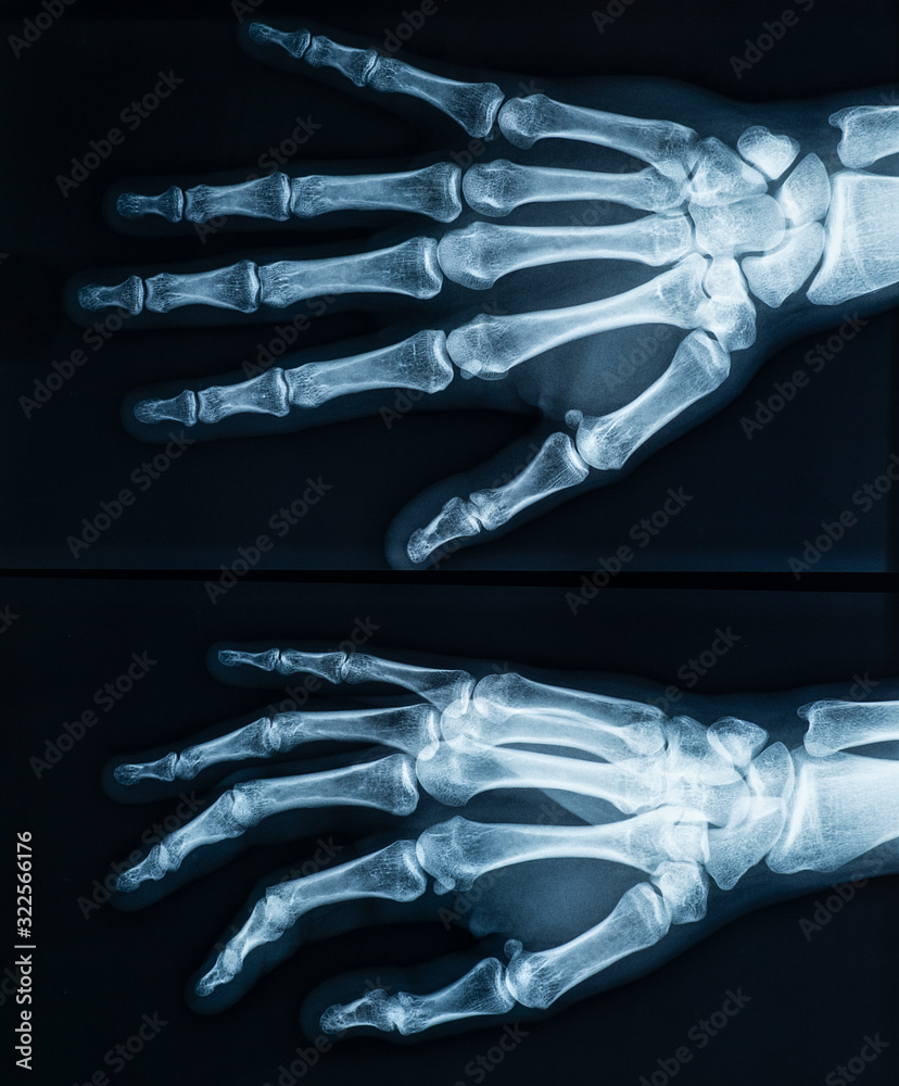 Human female adult right hand skeleton x-ray image. Medical and anatomy ...