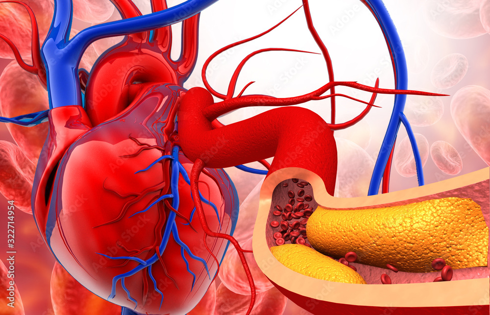 Cholesterol plaque in artery with human heart anatomy. 3d illustration ...