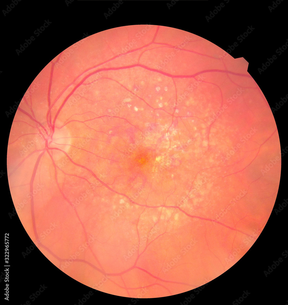 Medical photo retina diabetic retinopathy. Examination of the eye ...