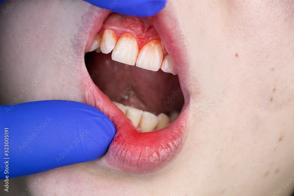 Gum bleeding and inflammation close up. A man examined by a dentist ...