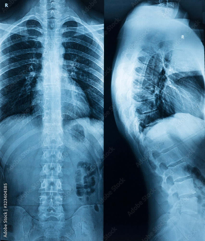 X-ray of the spine of a man with a stoop in two projections in full ...