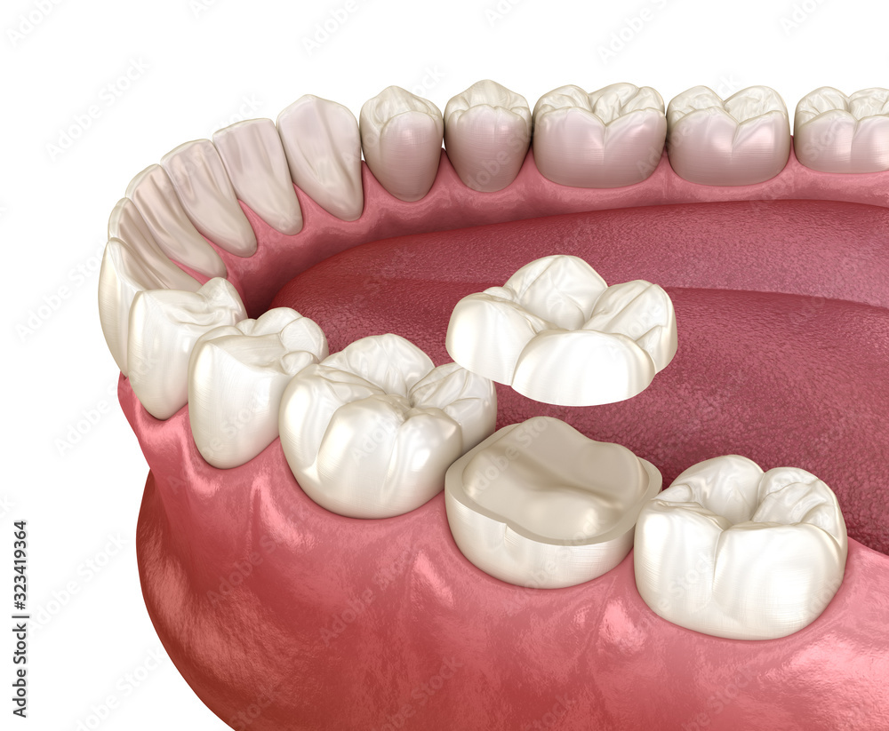 Onlay ceramic crown fixation over molar tooth. Medically accurate 3D ...