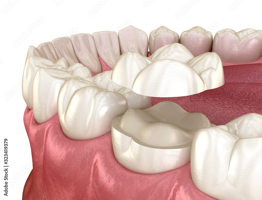 Onlay ceramic crown fixation over molar tooth. Medically accurate 3D ...