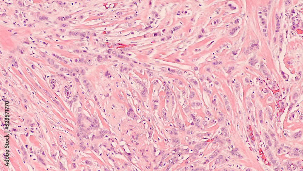 Breast cancer histology (biopsy): Microscopic image (photomicrograph ...