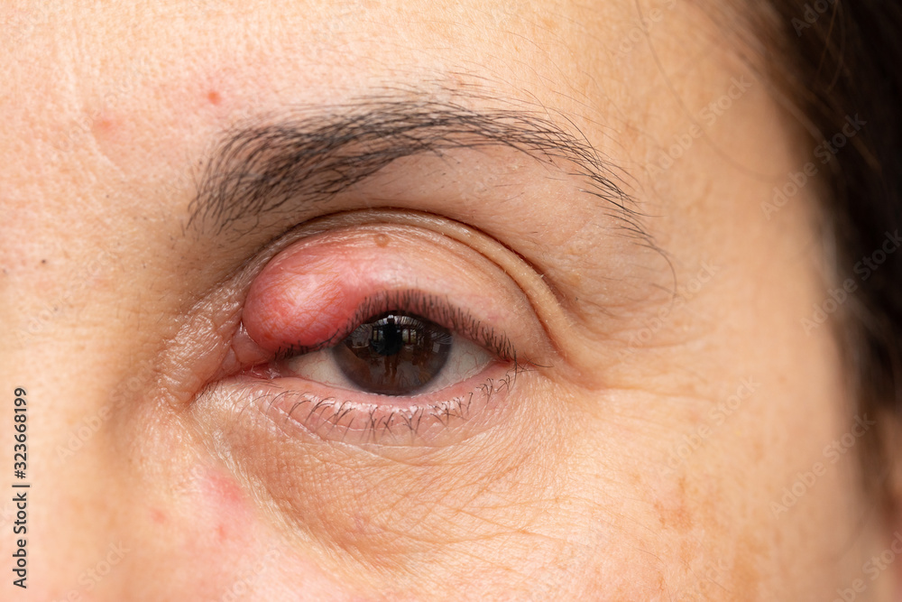 Chalazion Upper Eyelid