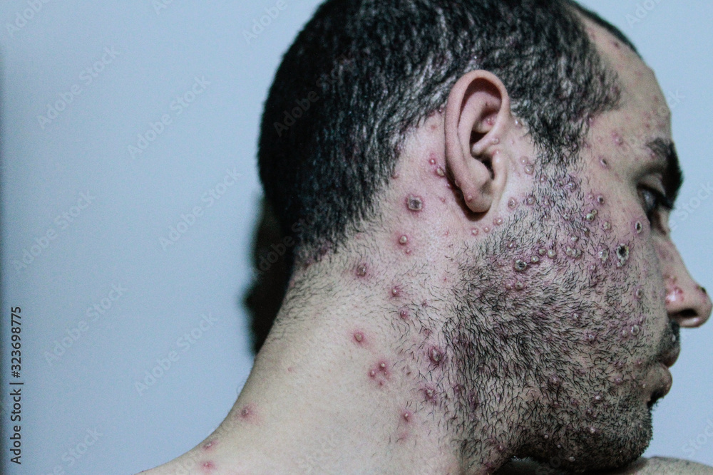 Adult man half face with strong aggressive varicella. Varicella or ...