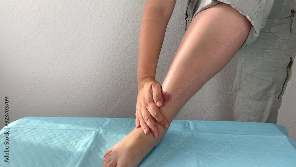 woman shows a wound on her leg, wound treatment. 4k, slow-motion ...