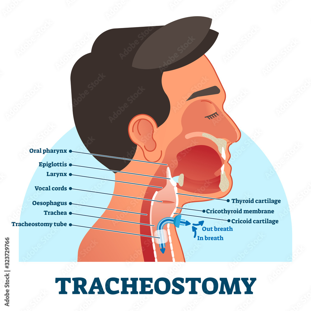 Tracheostomy cross section diagram, vector illustration Stock Vector ...