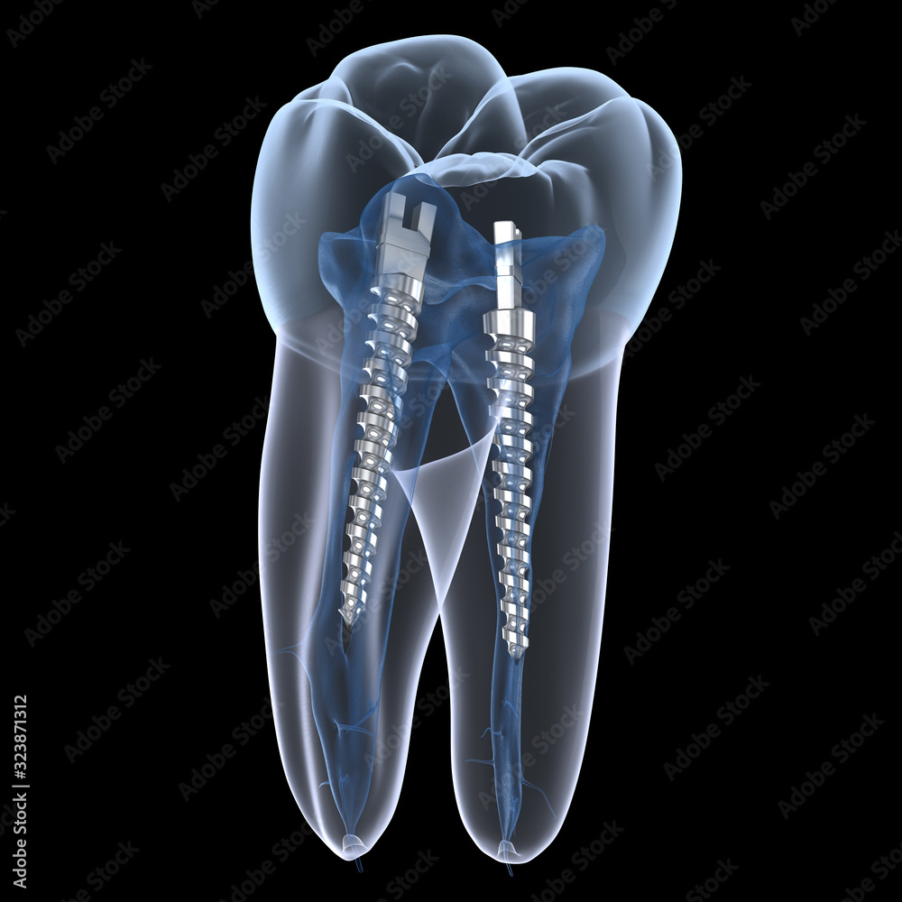 Dental steel post inside molar teeth, Xray view. Dental endodontic ...