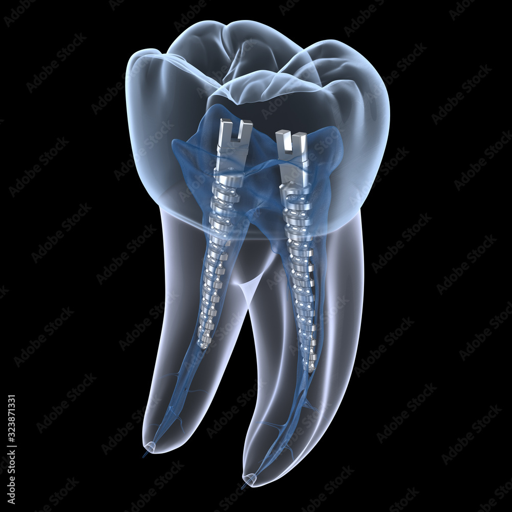Dental steel post inside molar teeth, Xray view. Dental endodontic ...