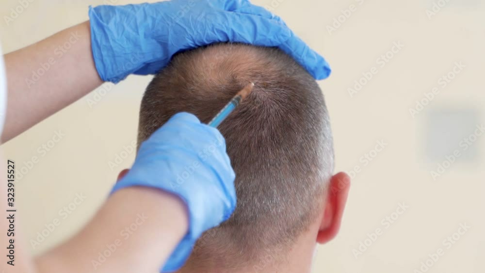 Hair mesotherapy or hair transplant: a beautician doctor makes ...