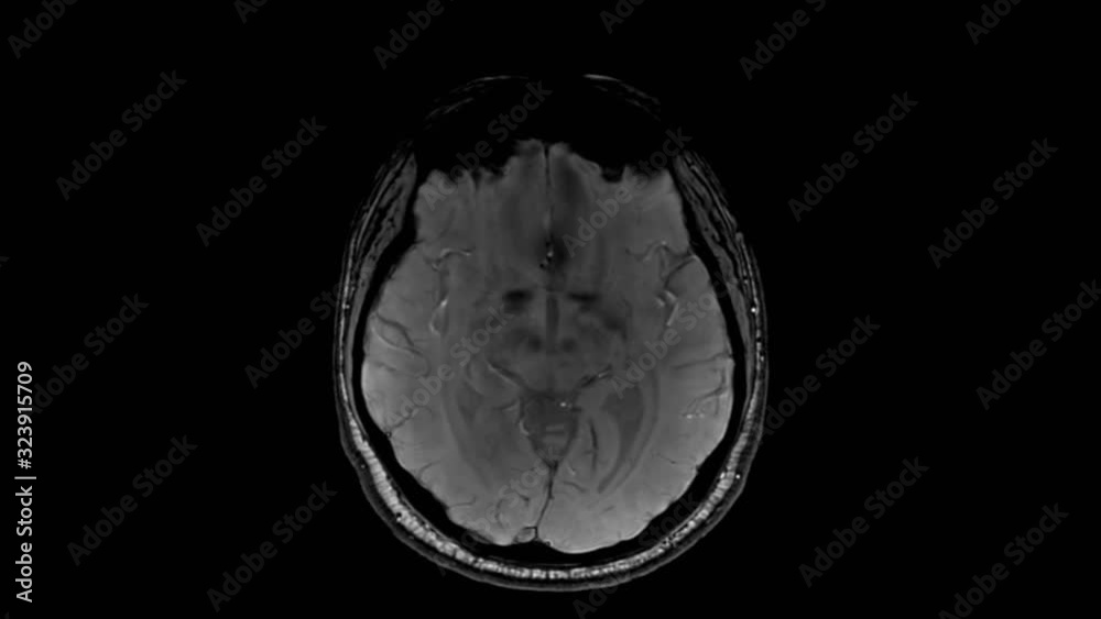 Cancer, Magnetic Resonance Imaging (MRI), Human brain real MRI scan ...