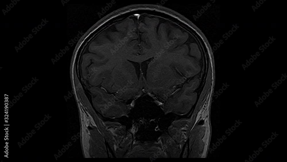 Computed medical tomography MRI upscaled scan of healthy young female ...