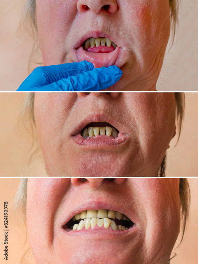 Periodontitis, an inflammatory process in the gums. Exposure of the ...