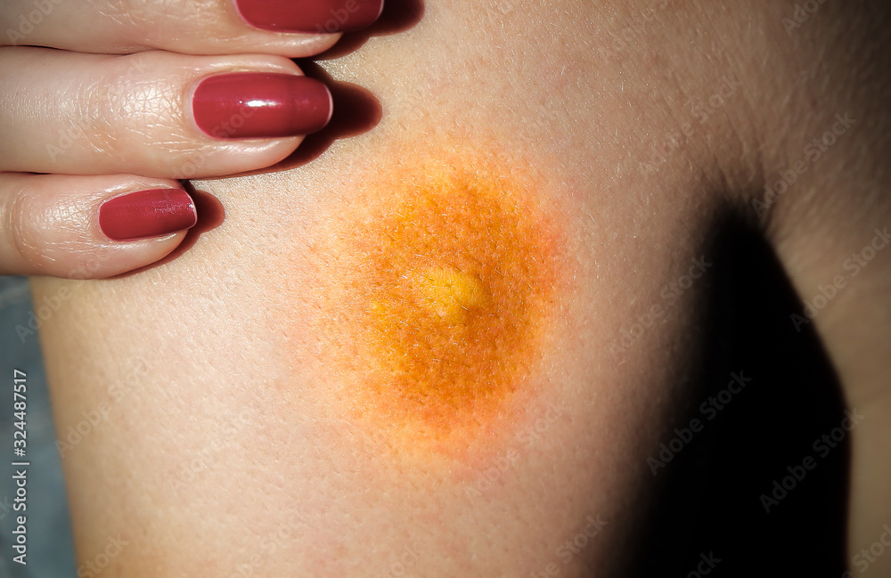 Mosquito bite on the shoulder. Insects in the summer. Dangerous nature ...