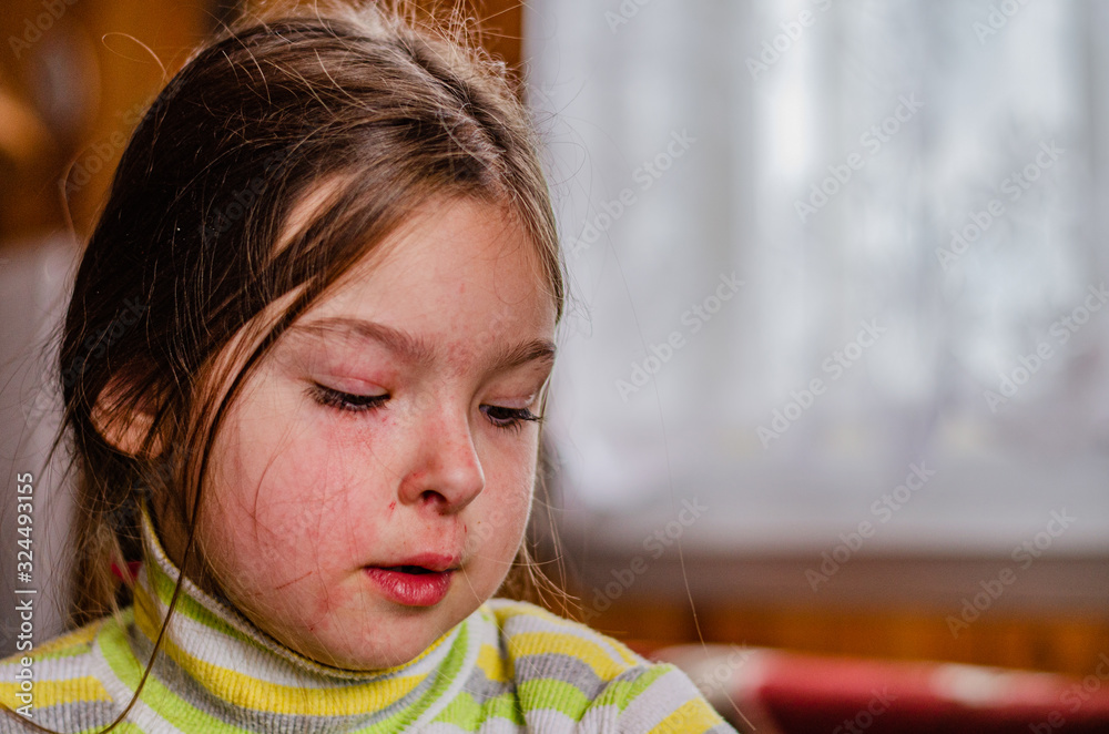 Sad girl child with hurt and scratches on the face from bump, insurance ...