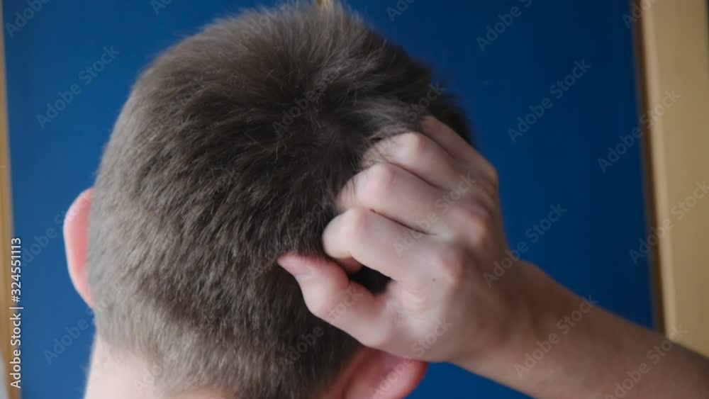 Problematic scalp: dandruff, rash, lice. A man scratches his head with ...